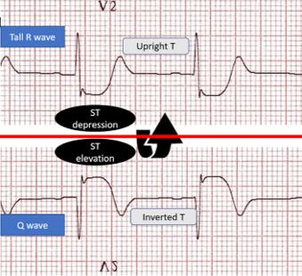 Posterior Myocardial Infarction Ecg
